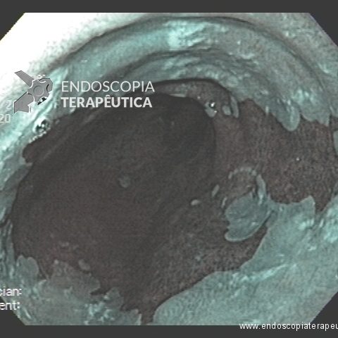 Esôfago de Barrett • Endoscopia Terapeutica