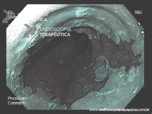 Esôfago de Barrett • Endoscopia Terapeutica