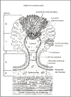 Classificação de Haggitt • Endoscopia Terapeutica