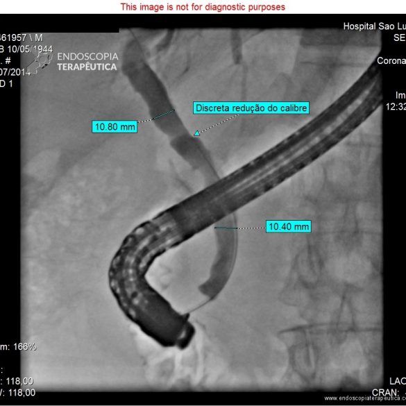 Estenose de anastomose colédoco-colédoco pós Tx hepático • Endoscopia ...