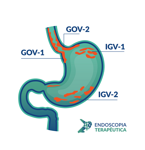 Classificação endoscópica das varizes gástricas - Sarin • Endoscopia ...