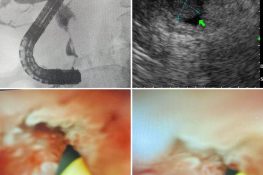 Tratamiento del Vólvulo de Colon y de la Pseudo-Obstrucción Aguda del ...