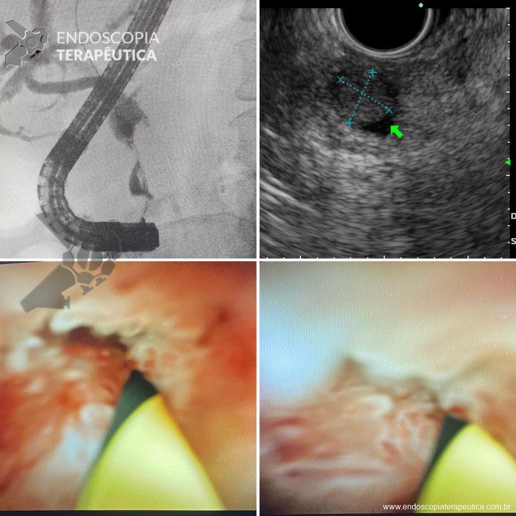 Estenosis biliar indeterminada – importantes conceptos que necesitas ...