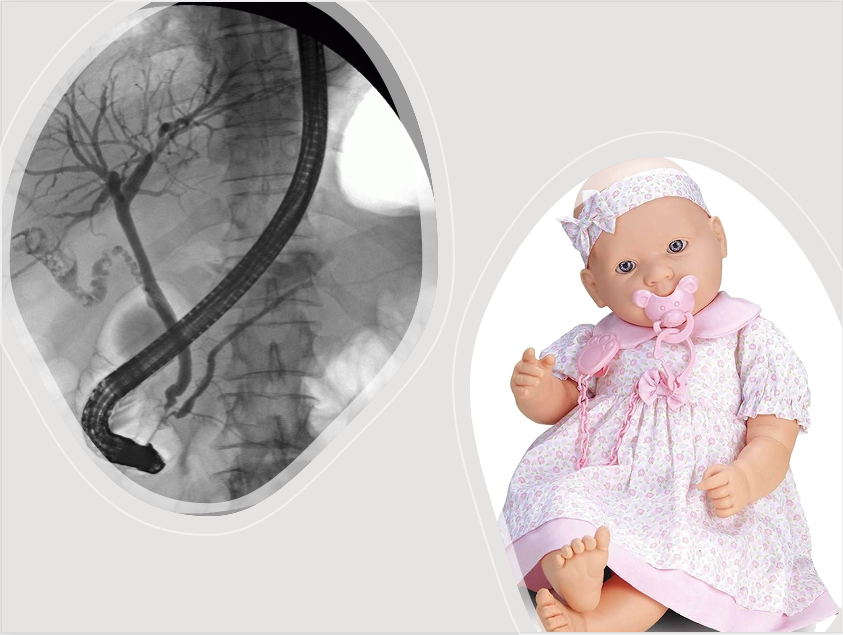 CPRE en pacientes pediátricos • Endoscopia Terapeutica