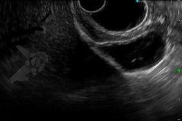 Técnica Convencional de Disección Submucosa Endoscópica (ESD) de Colon ...