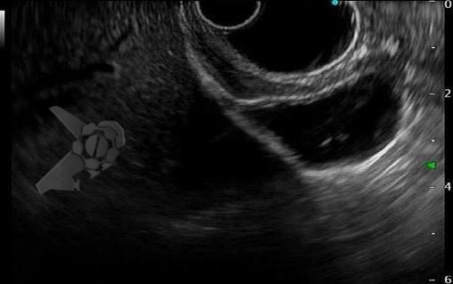 Microlitiasis biliar y dispepsia • Endoscopia Terapeutica