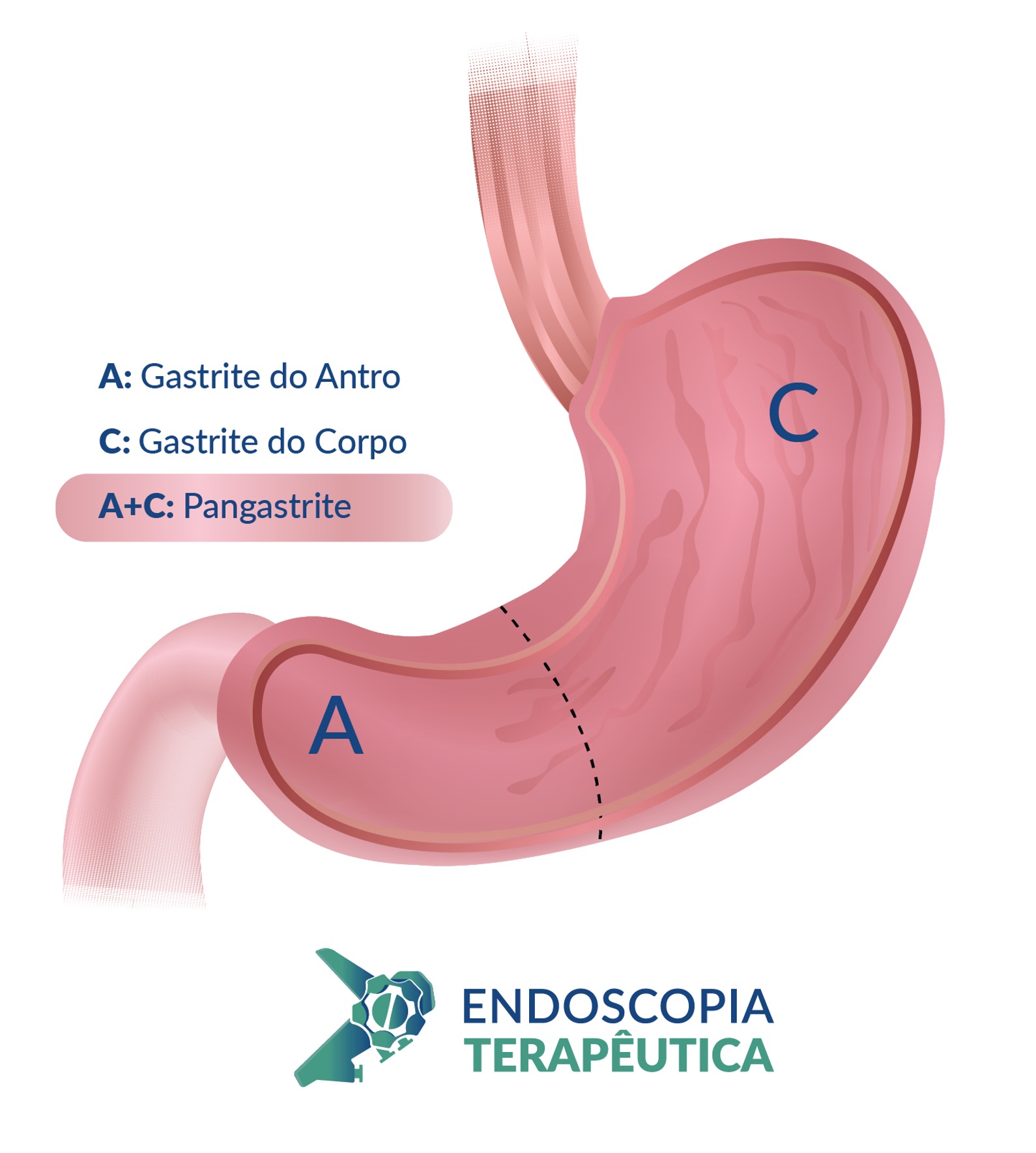 Gastrites - Sistema Sidney • Endoscopia Terapeutica