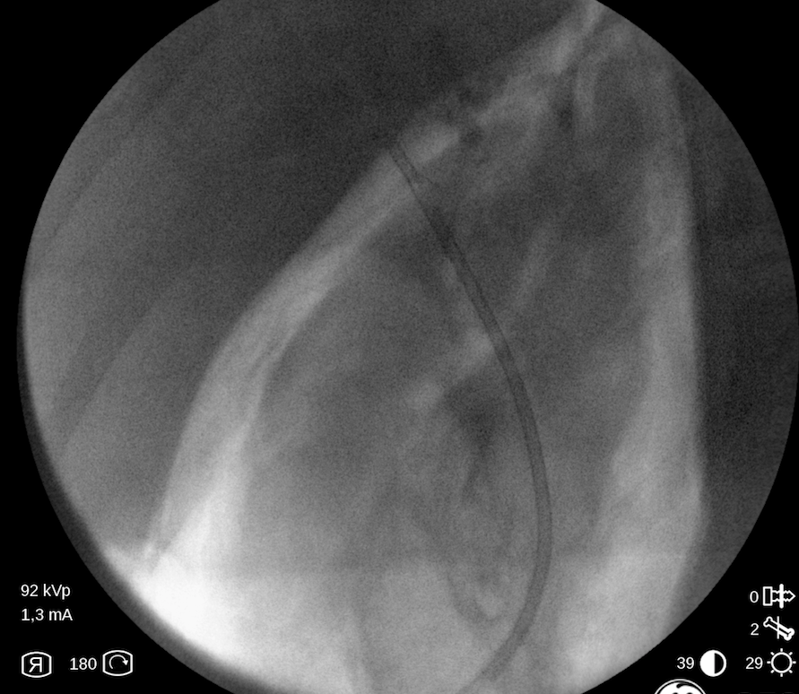 STAPFER – PERFURAÇÃO PÓS-CPRE • Endoscopia Terapeutica