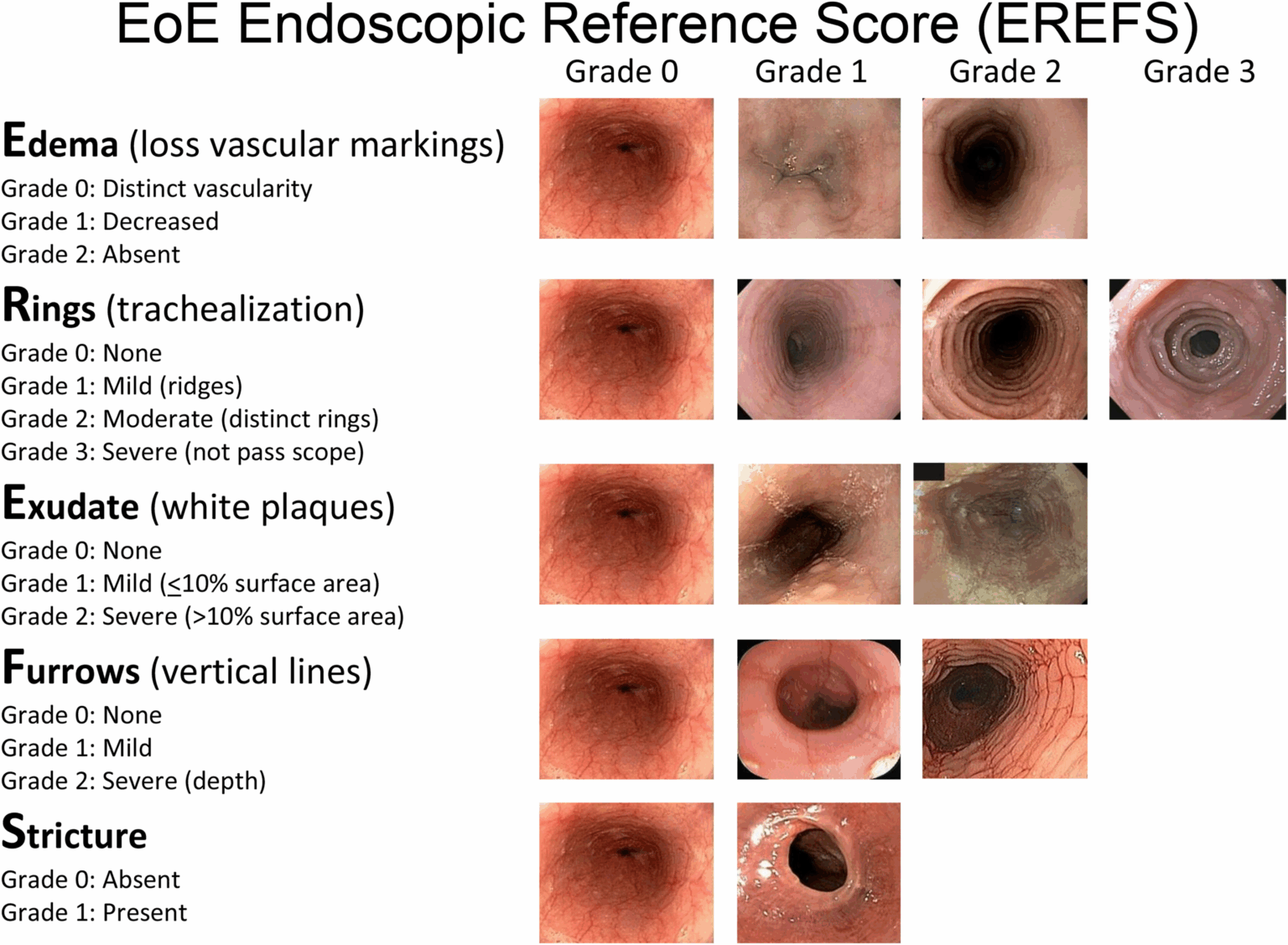 Esofagite Eosinofílica - EREFS • Endoscopia Terapeutica